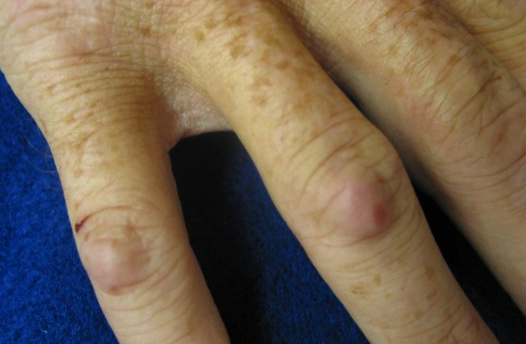 Understanding arthritis | Michigan Today